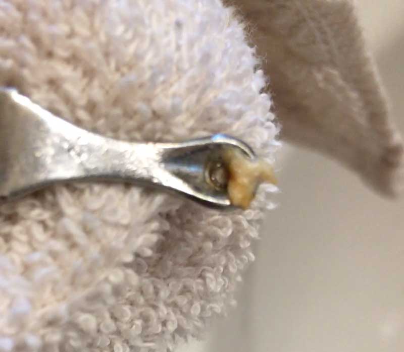 Removing Wax and Parasites From The Inner Ears - Earther Academy